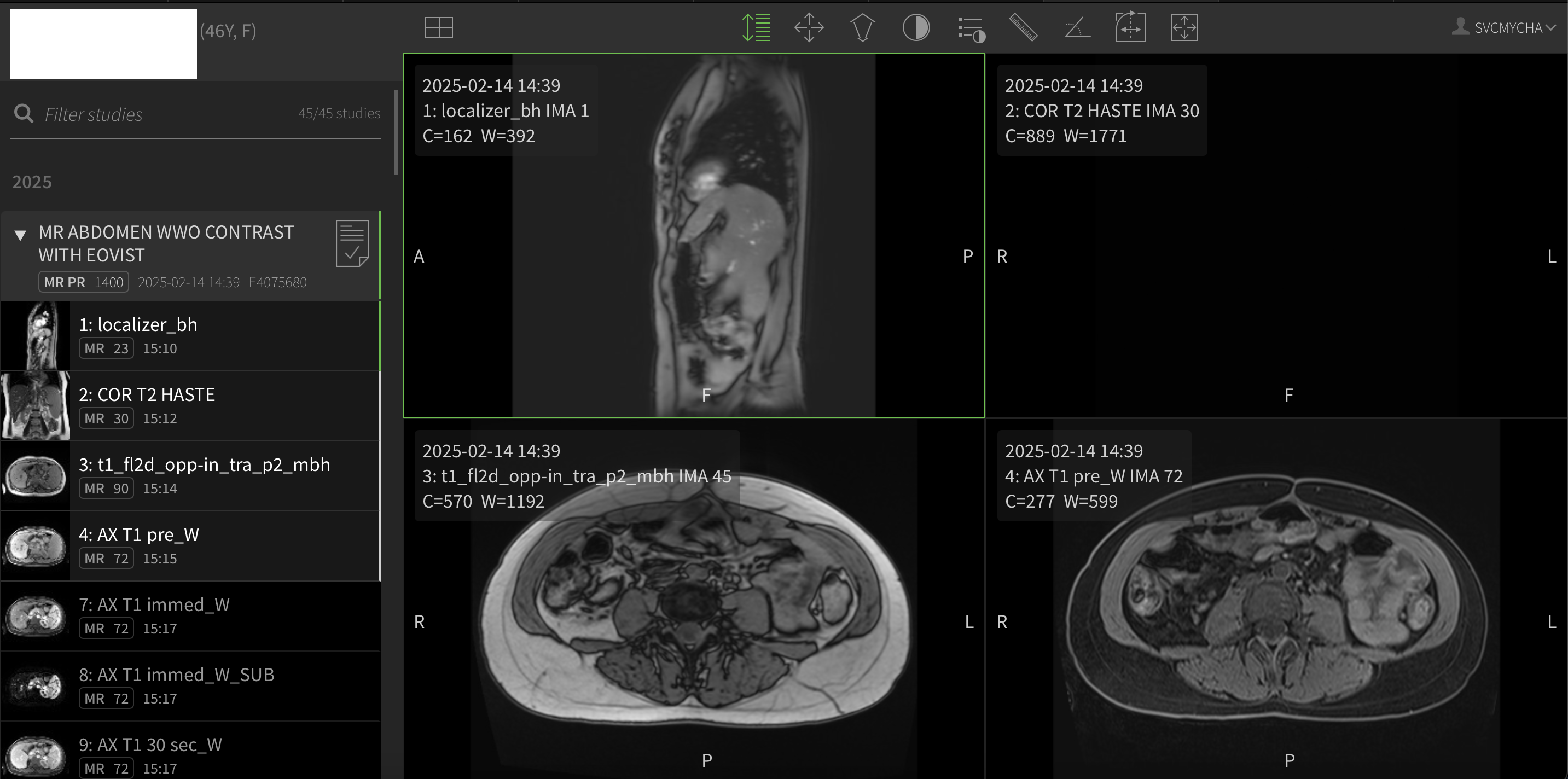 Scanxiety! – Cancer Story… Go!